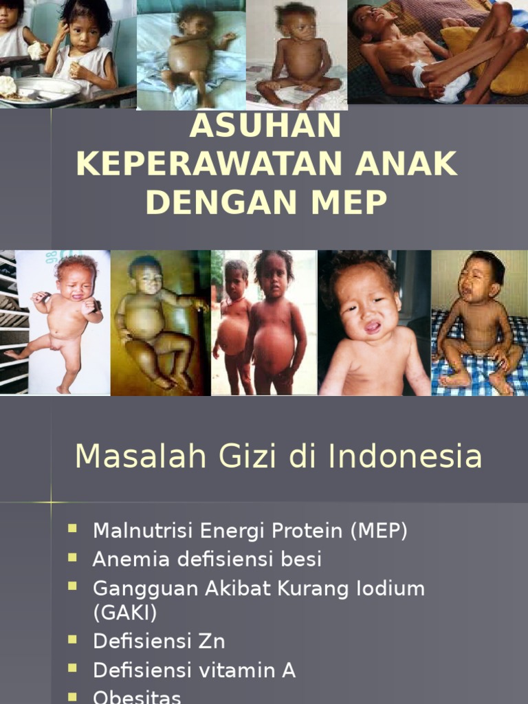 Askep Anak Dengan Kurang Kalori Protein (Mep) | PDF