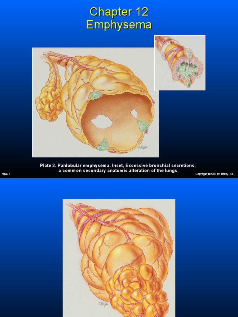 Emphysema | Chronic Obstructive Pulmonary Disease | Respiratory Tract