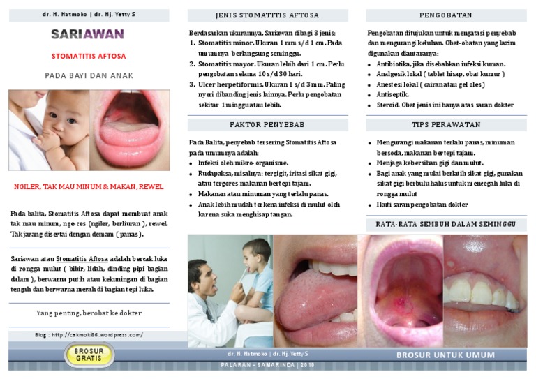 Stomatitis Aftosa Sariawan | PDF