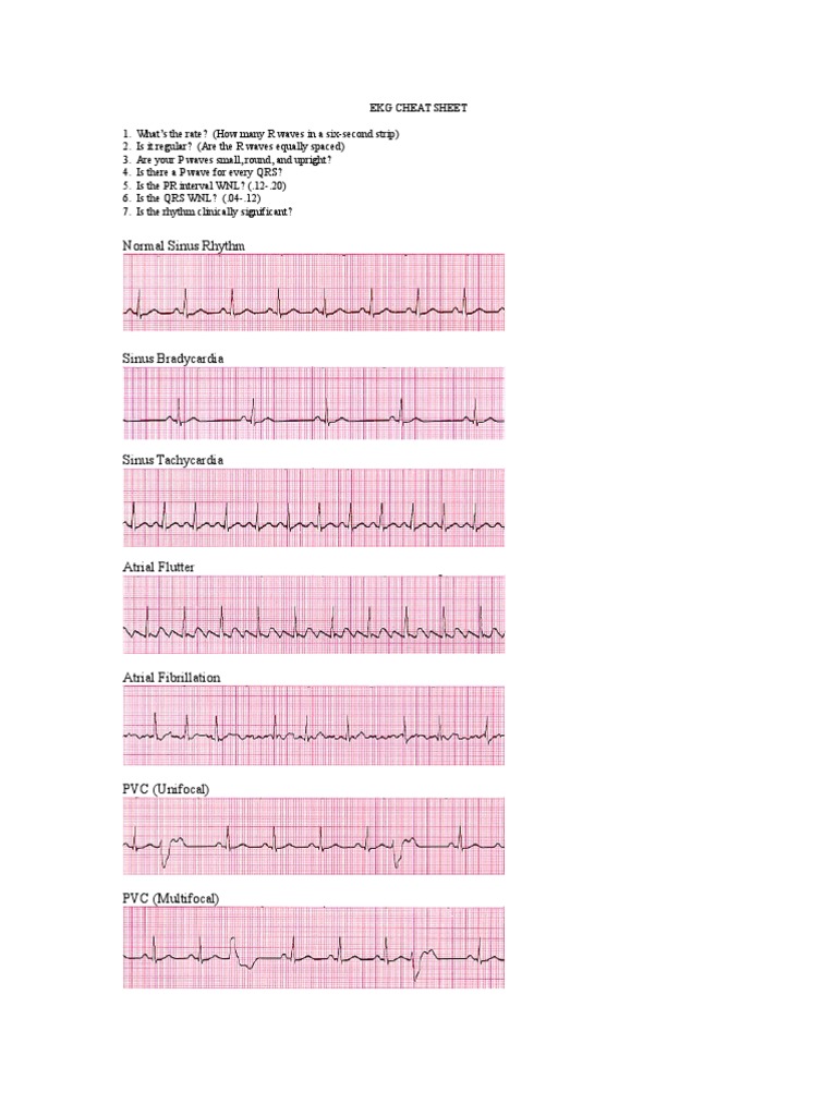Ekg Cheat Sheet | PDF