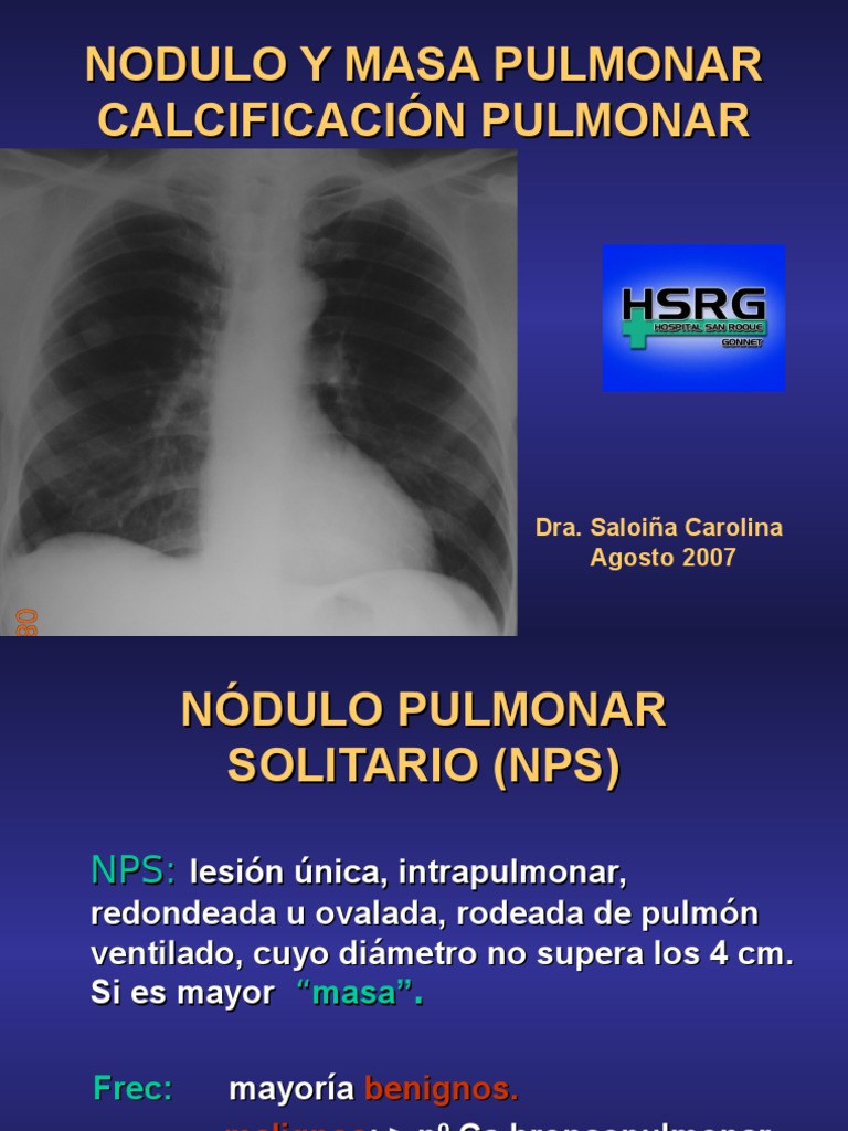 Nodulo Pulmonar | PDF | Sarcoma | Metástasis