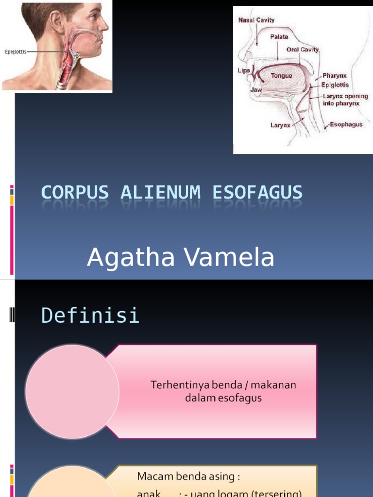 Corpus Alienum Esofagus | PDF