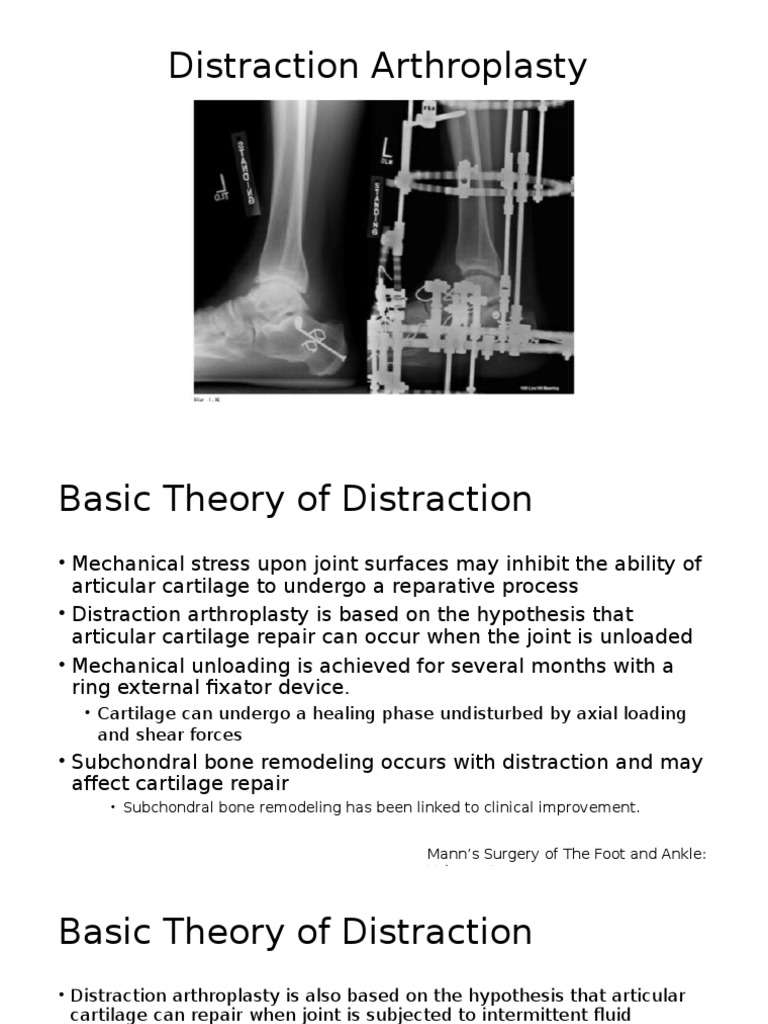 Ankle Distraction Arthroplasty | PDF | Osteoarthritis | Ankle