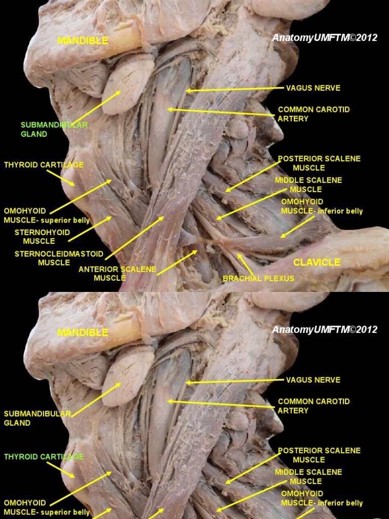 Anterior Scalene Cadaver
