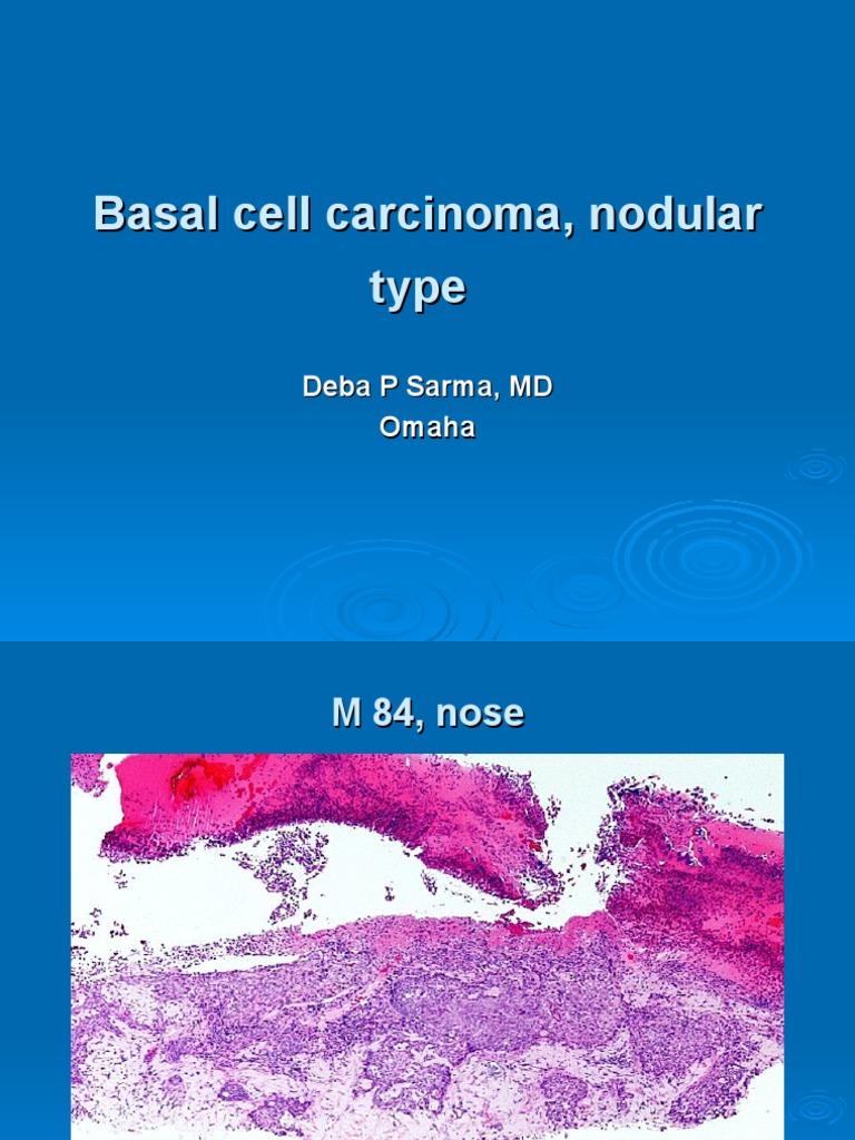 Basal Cell Carcinoma, Nodular Type. M 84, Nose. | PDF
