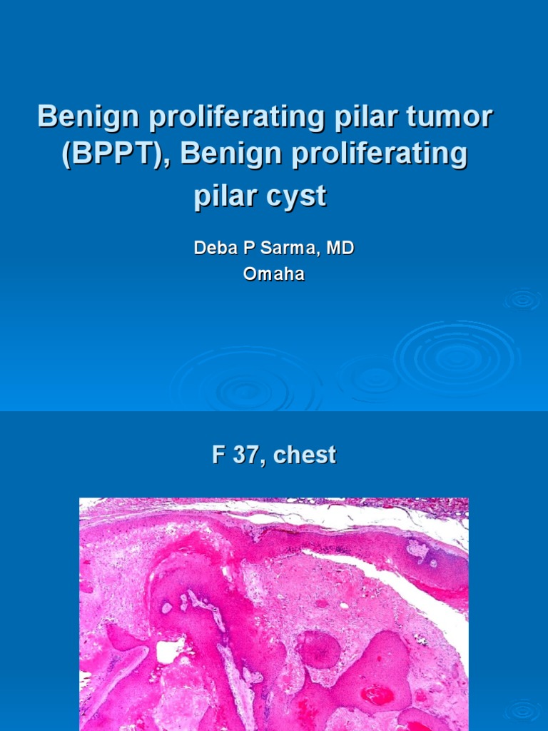 Benign Proliferating Pilar Tumor (BPPT) - F 37, Chest. | PDF