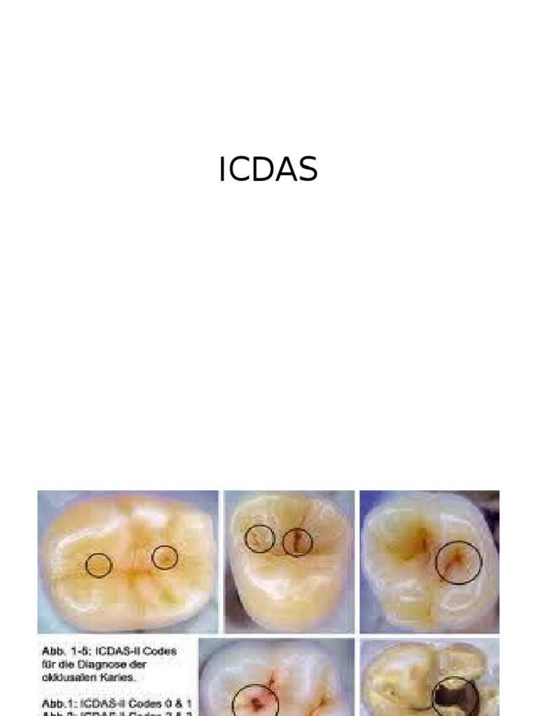 Klasifikasi Karies Berdasarkan ICDAS | PDF