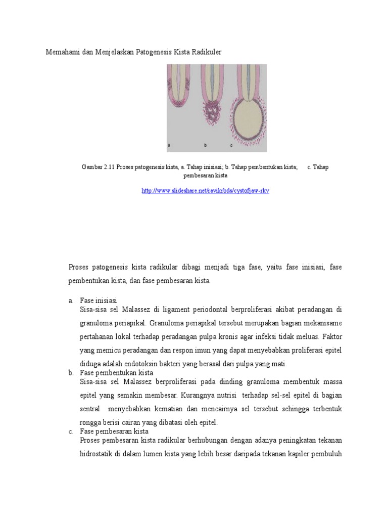 Patogenesis Kista Radikuler | PDF