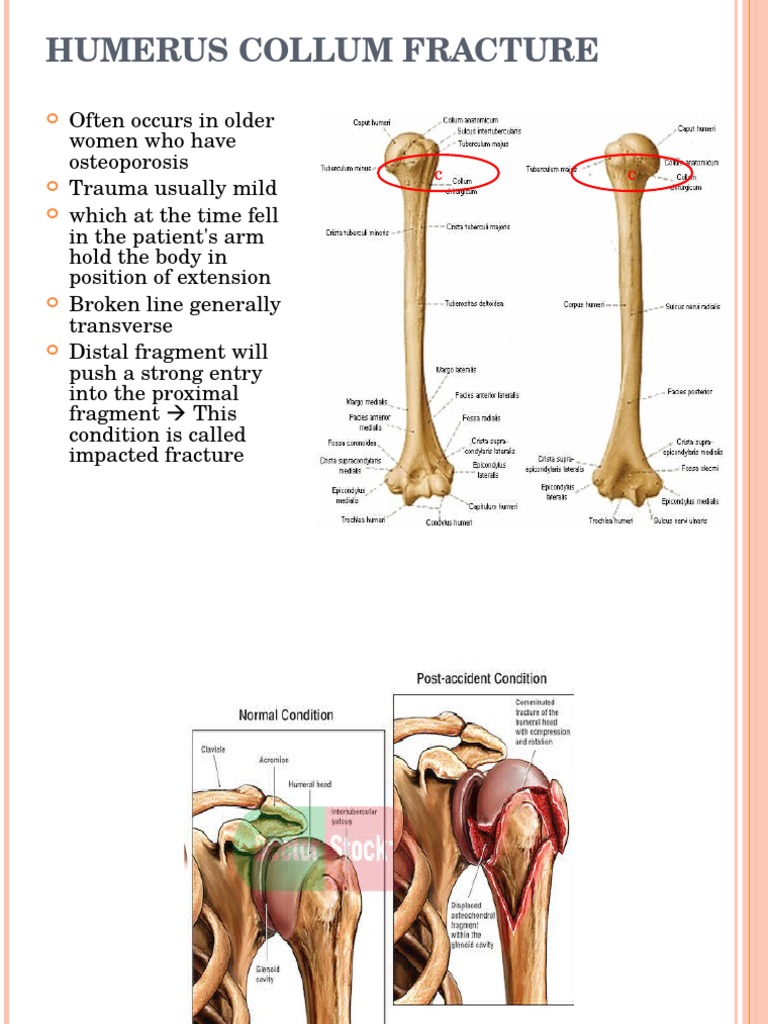 fraktur humerus English | Shoulder | Arm