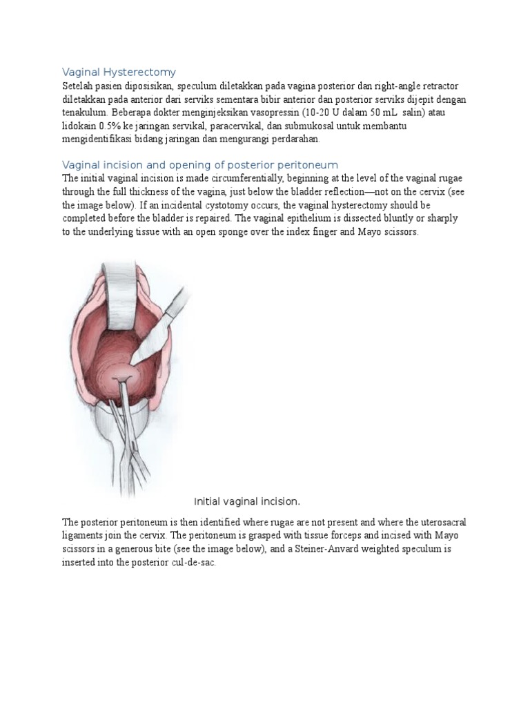Vaginal Hysterectomy | Uterus | Vagina