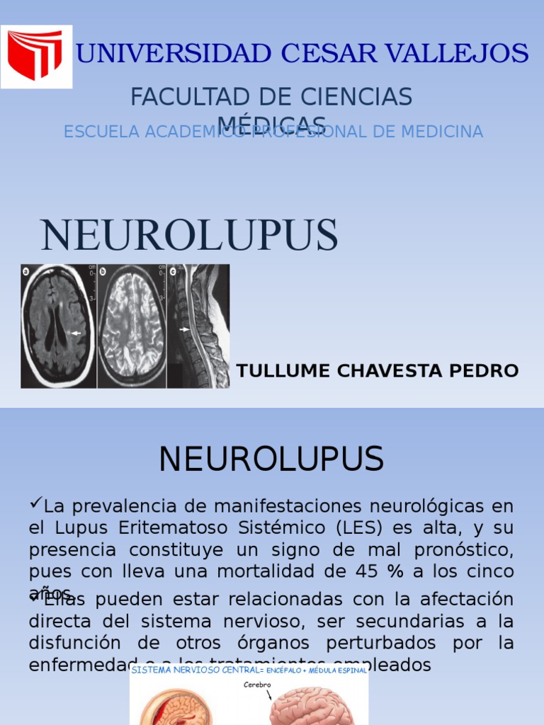 Neuro Lupus | Lupus eritematoso sistémico | Neurología