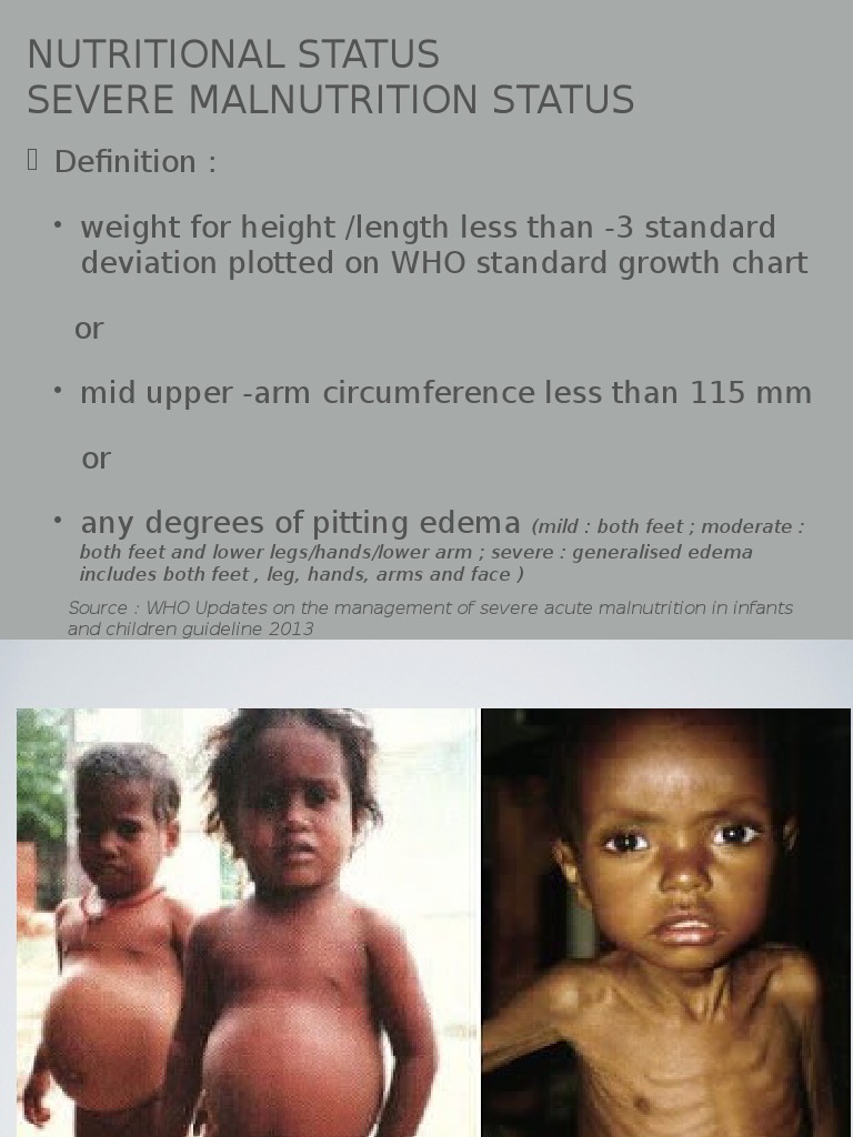 Kwashior and Marasmus | PDF | Dehydration | Malnutrition