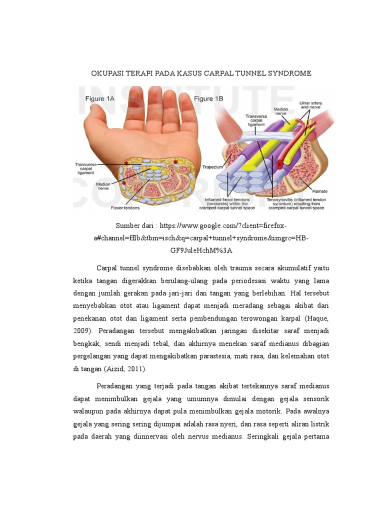 Terapi untuk Carpal Tunnel Syndrome | PDF