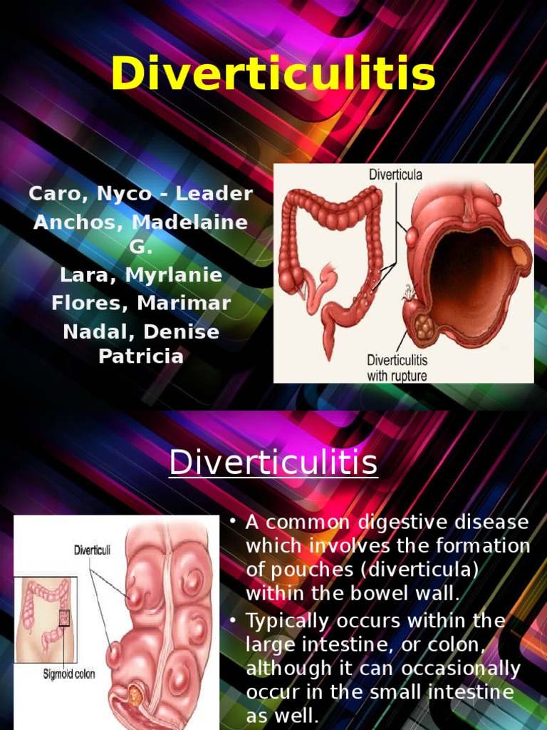 Case Study Diverticulitis | PDF | Clinical Medicine | Medical Specialties