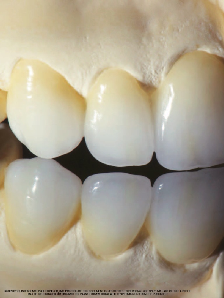 Esthetic Wax-Up - Lasseigne - 2009 | PDF | Tooth Enamel | Dentistry ...