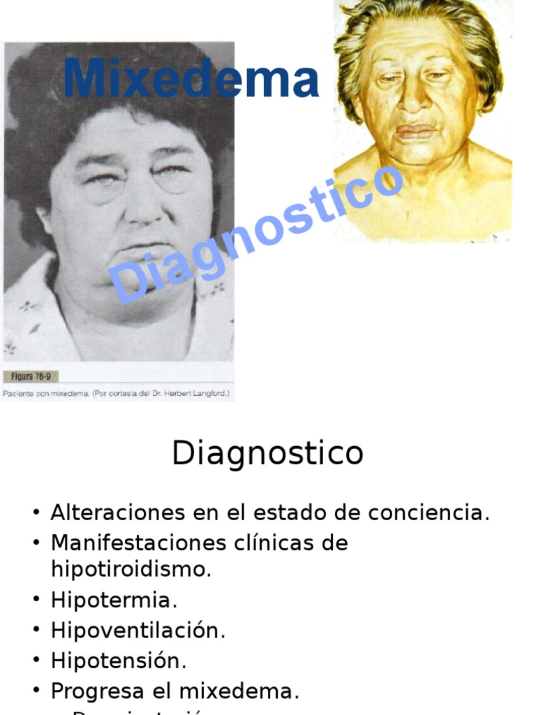 Hipotiroidismo y Mixedema | PDF | Hipotiroidismo | Hormona estimulante ...
