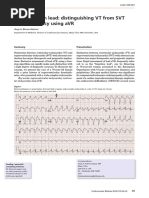Ventricular Tachycardia - Monomorphic VT - LITFL | PDF ...
