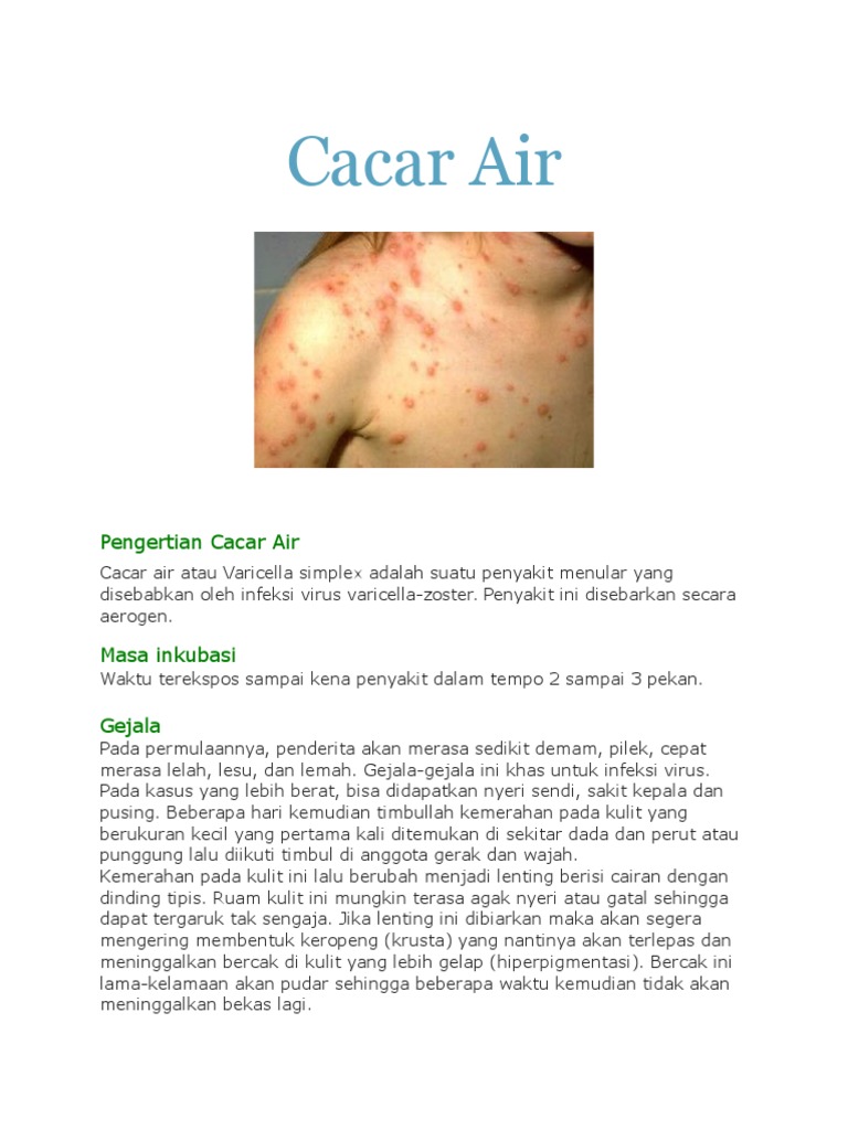 Cacar Air | PDF
