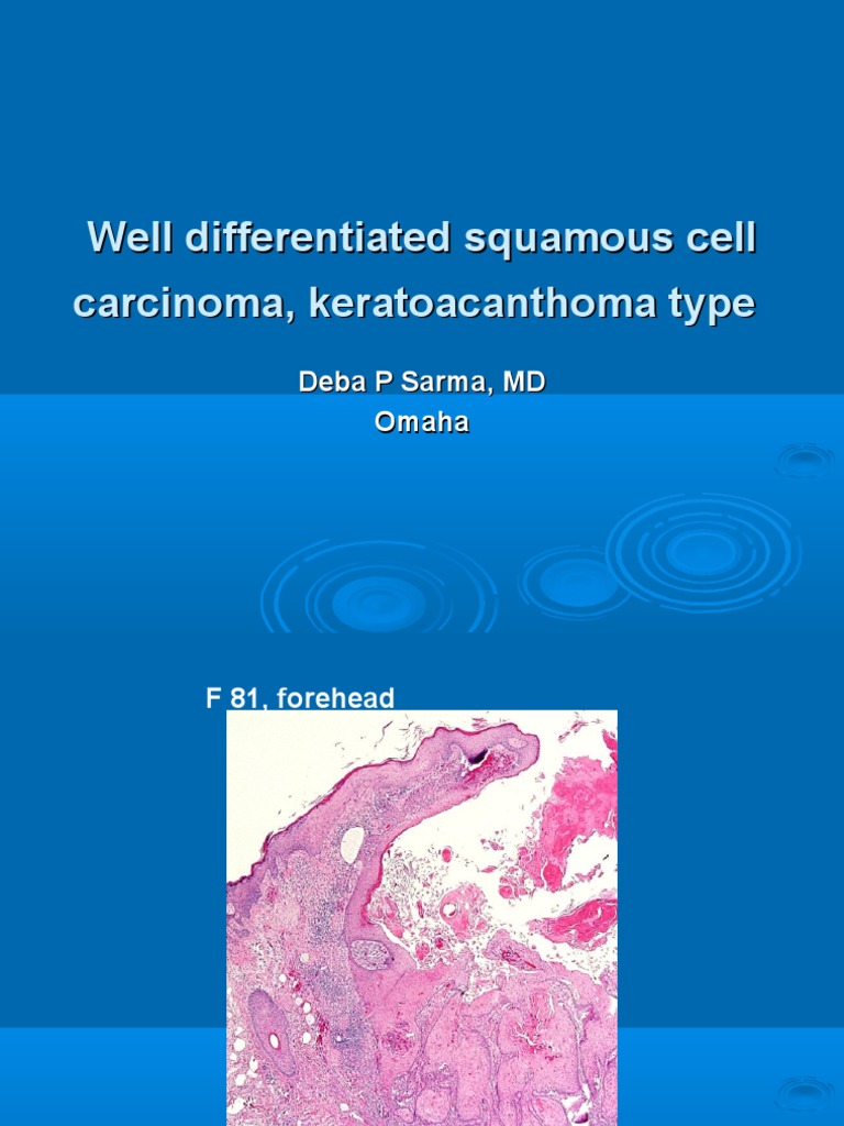 Well Differentiated Squamous Cell Carcinoma, Keratoacanthoma Type, F 81 ...