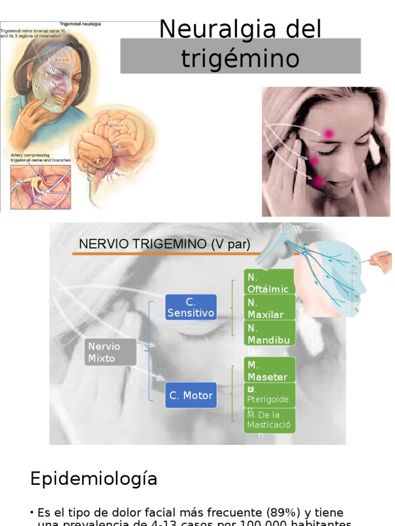 Neuralgia Del Trig mino PDF Neurolog a Especialidades Medicas