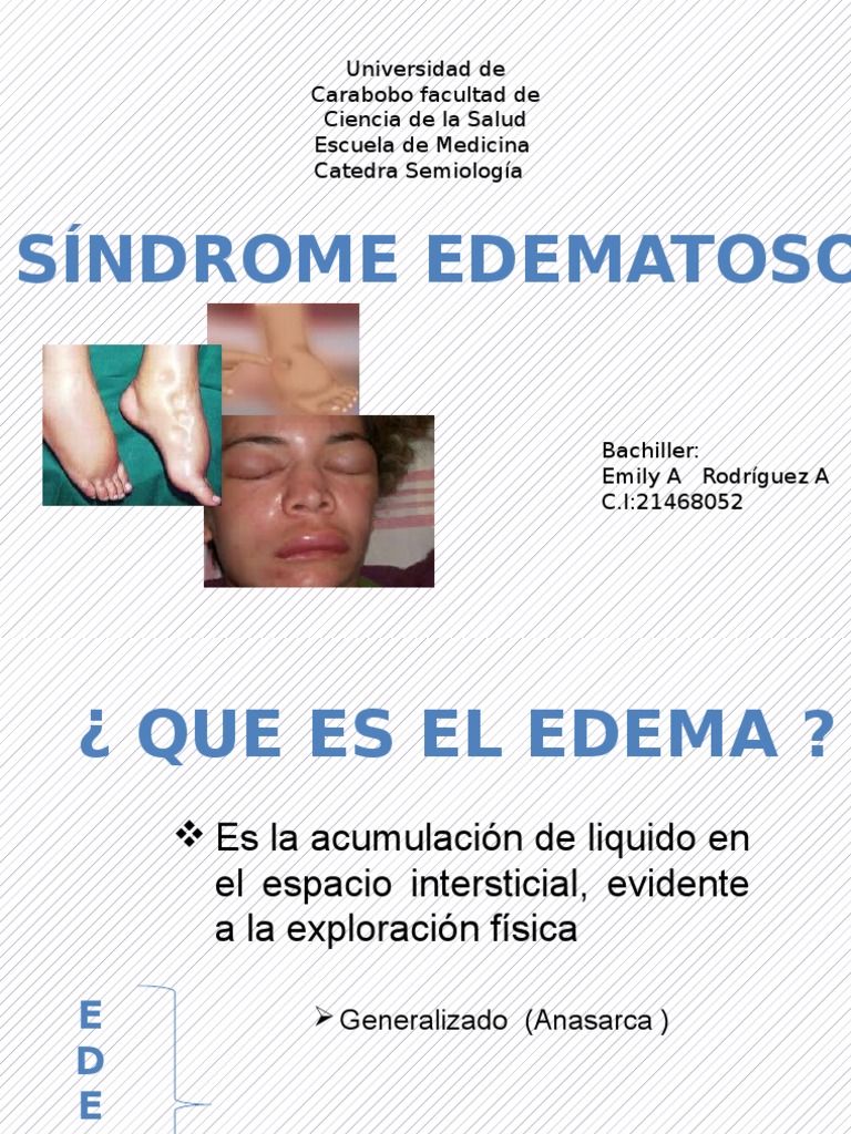 Sindrome Edematoso | PDF | Edema | Especialidades Medicas