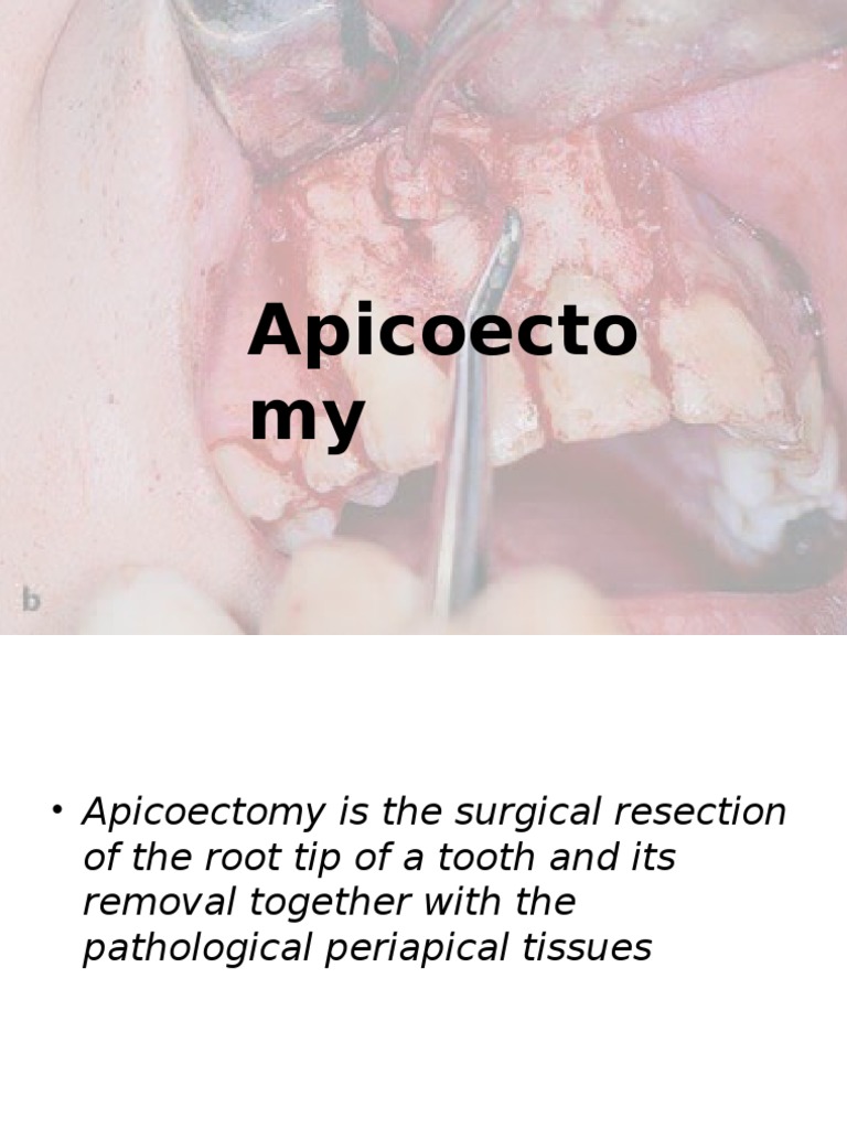 Apicoectomy | PDF