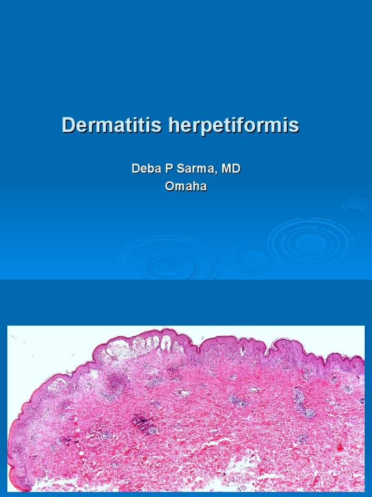 Dermatitis Herpetiformis.