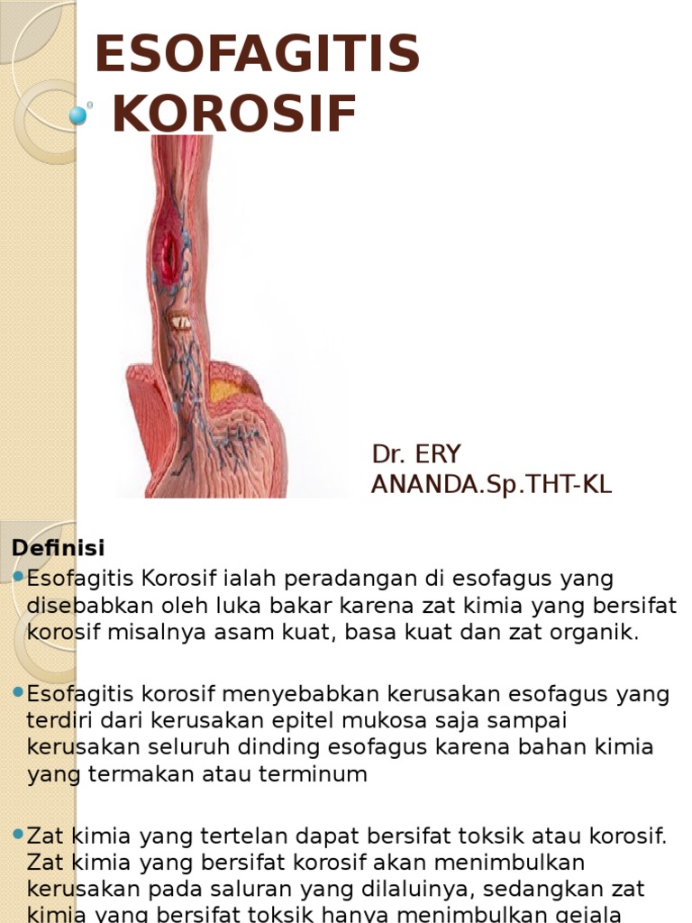 Esofagitis Korosif | PDF