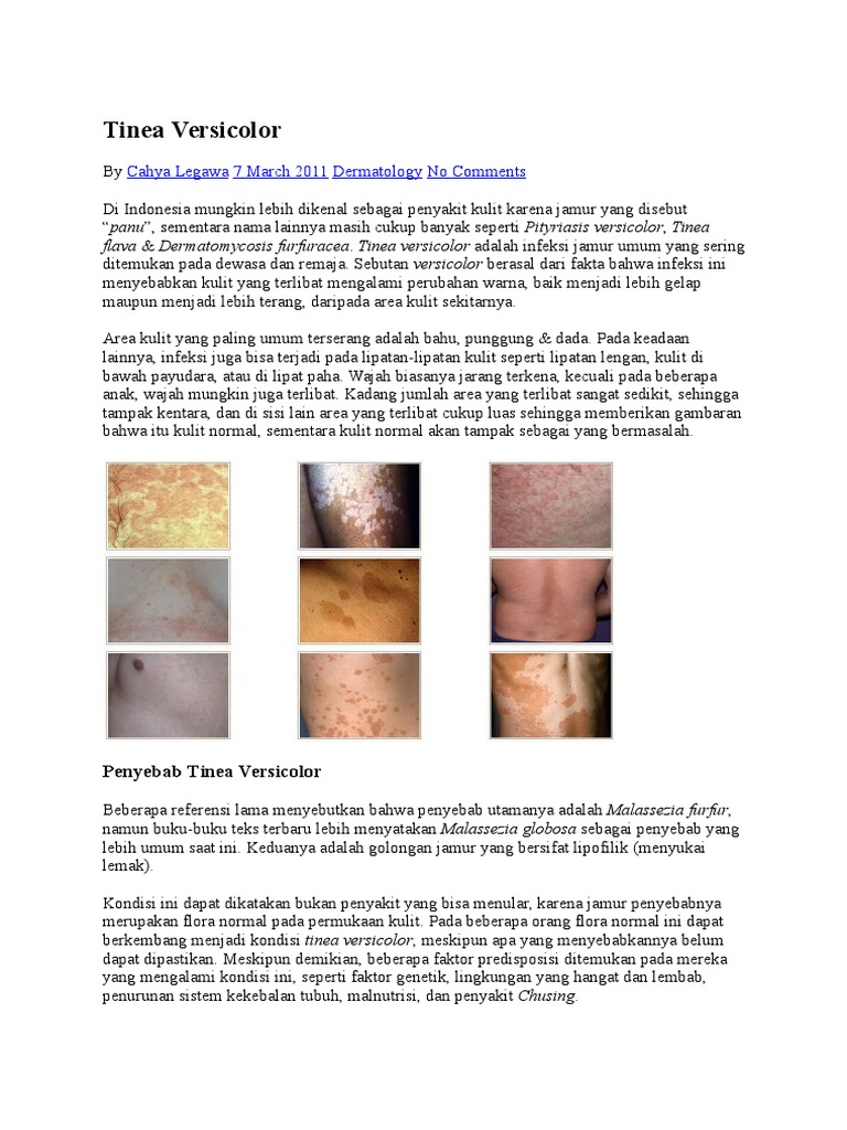 Tinea Versicolor | PDF