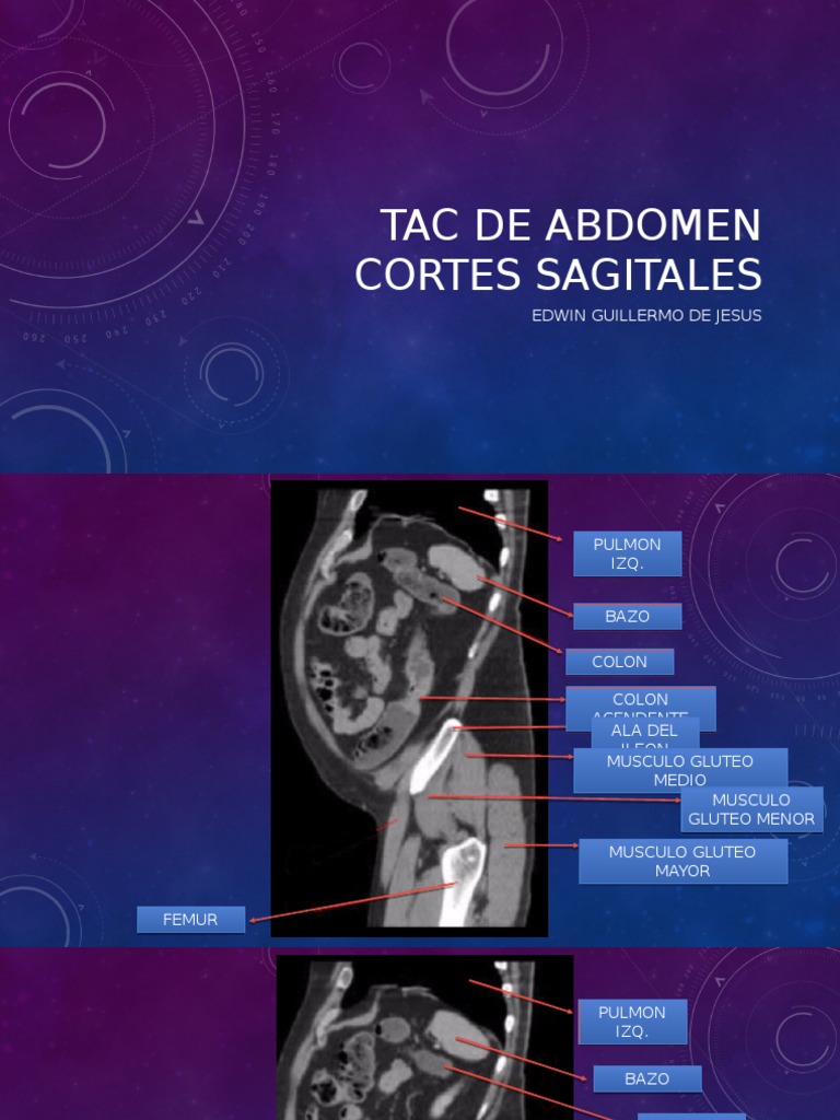 TAC de Abdomen Cortes Sagitales | PDF