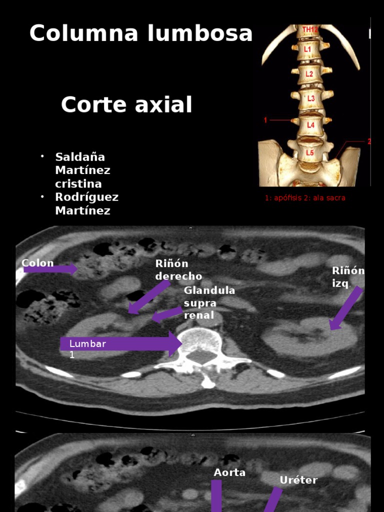 Anatomía de la Columna Lumbosacra | PDF | La columna vertebral | Riñón