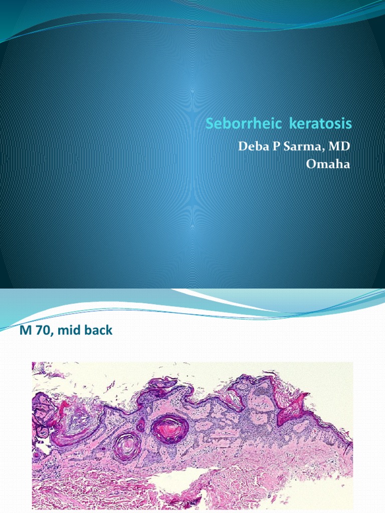 Seborrheic Keratosis. M 70, Mid Back. | PDF