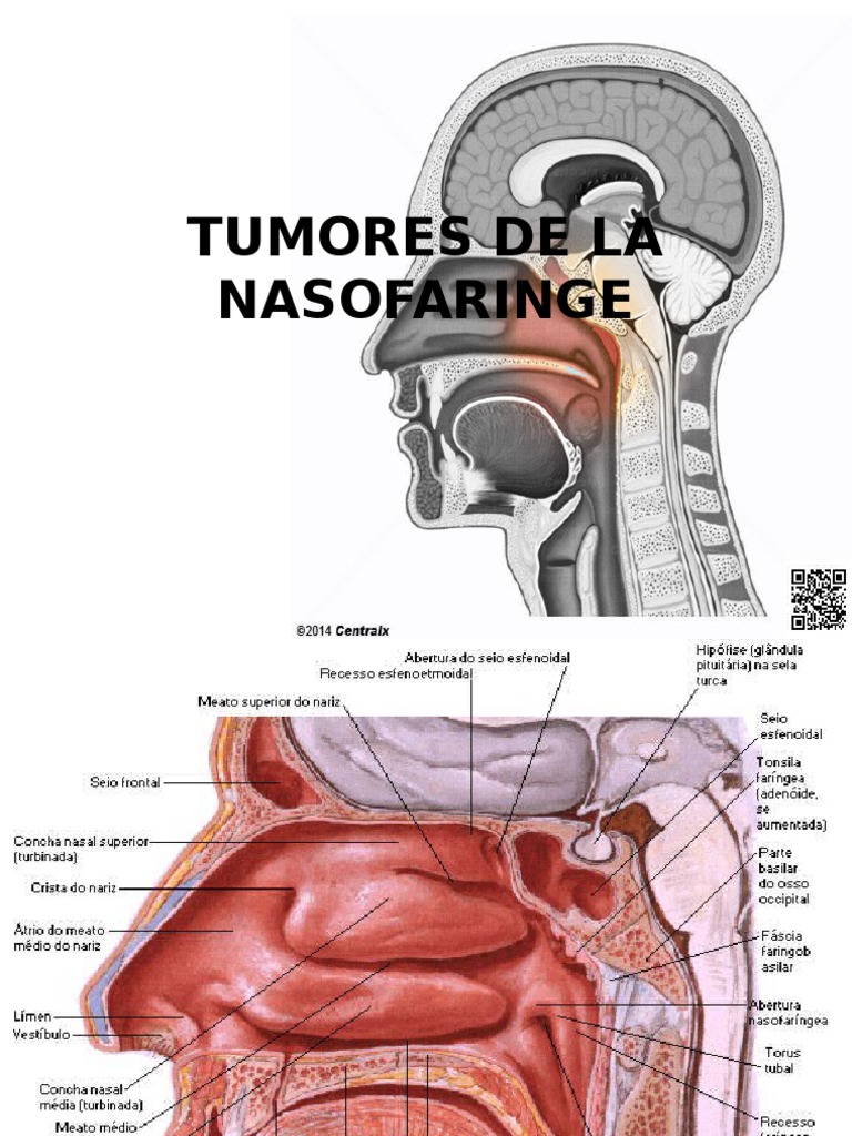 Tumores de La Nasofaringe