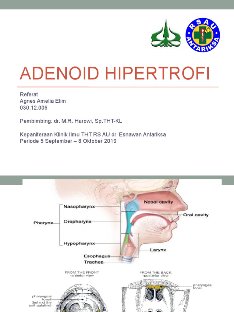 Hipertrofi Adenoid Referat | PDF