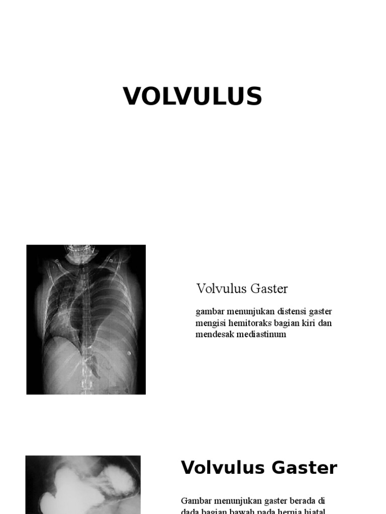Volvulus | PDF | Perjalanan | Sejarah