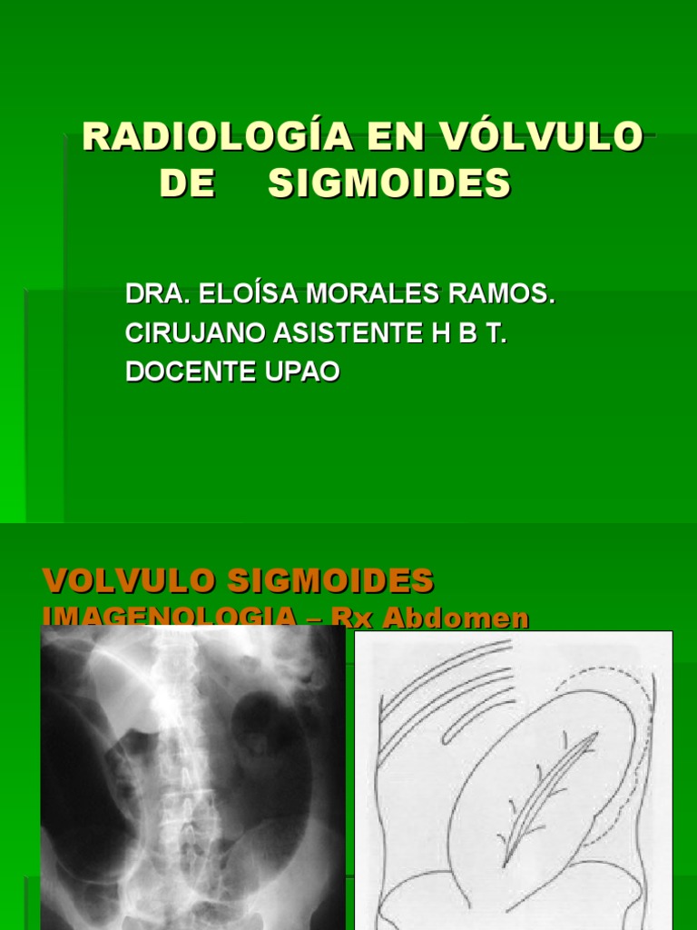 RX. Vólvulo de Sigmoides