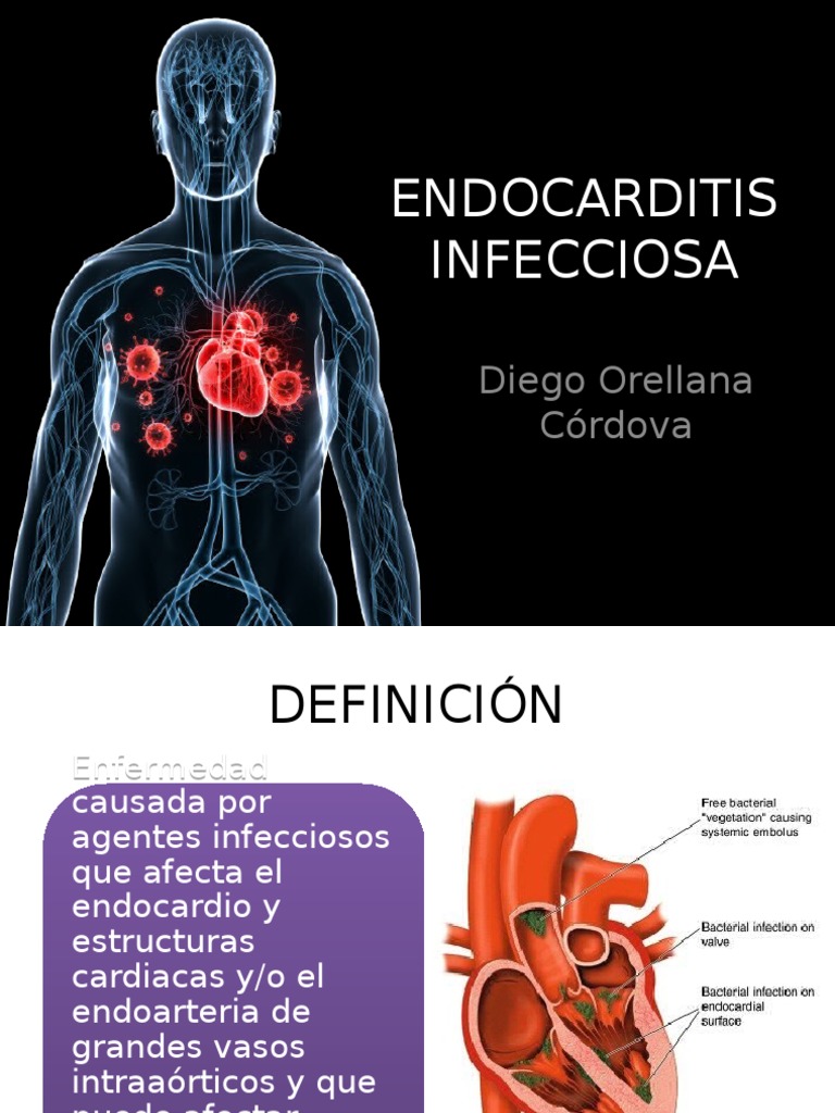 Endocarditis Infecciosa | Enfermedades y trastornos | Salud pública