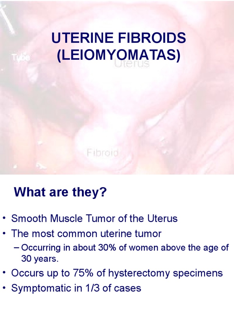 Uterine Fibroids | PDF | Uterus | Sexual Health