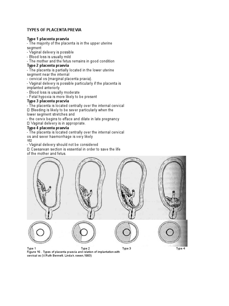 Placenta Previa Types