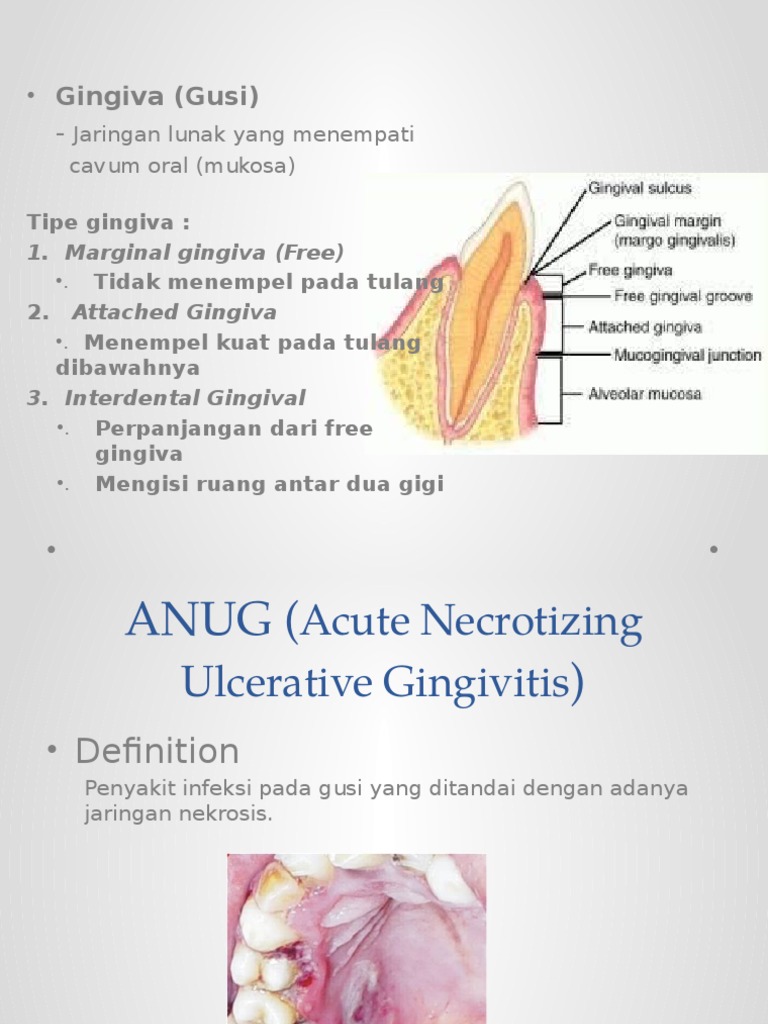 Gingivitis Nekrotikans Akut: Gejala dan Penanganan | PDF | Kesehatan ...