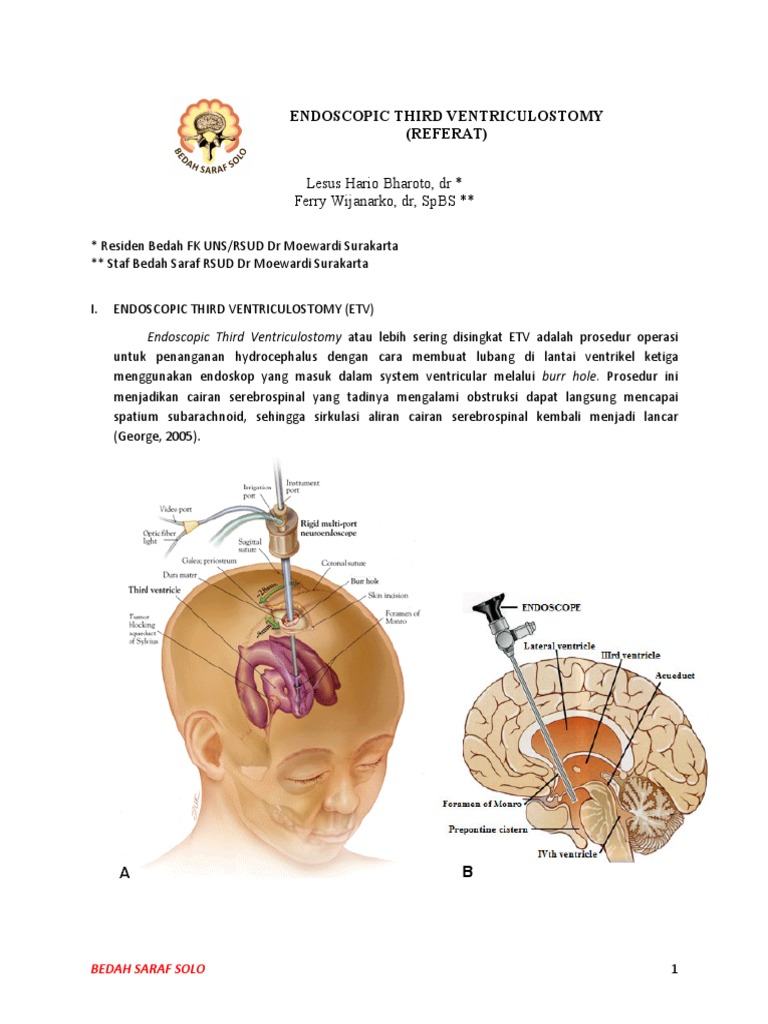 Endoscopic Third Ventriculostomy (Referat) : Lesus Hario Bharoto, DR ...