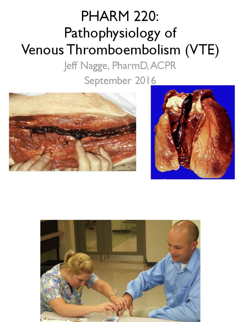 Venous Thromboembolism (VTE) Pathophysiology September 2016 | PDF ...