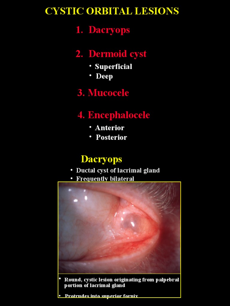 Cystic Orbital Lesions: 1. Dacryops 2. Dermoid Cyst | PDF | Science ...