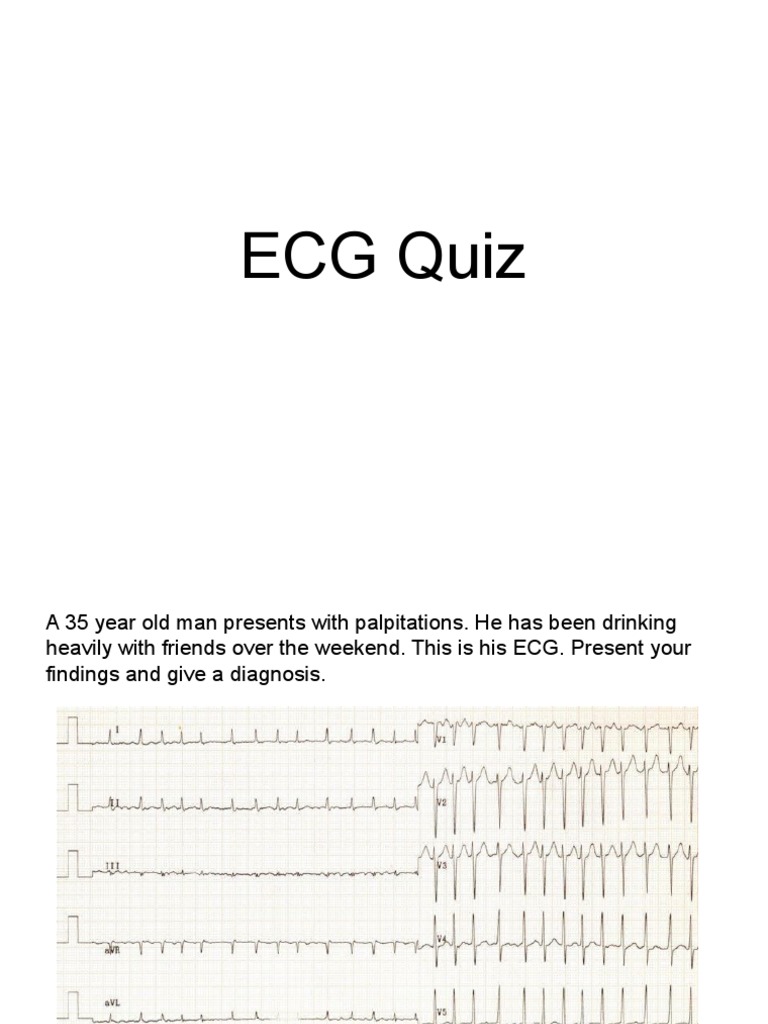ECG Identification Quiz.ppt | Thorax | Symptoms And Signs