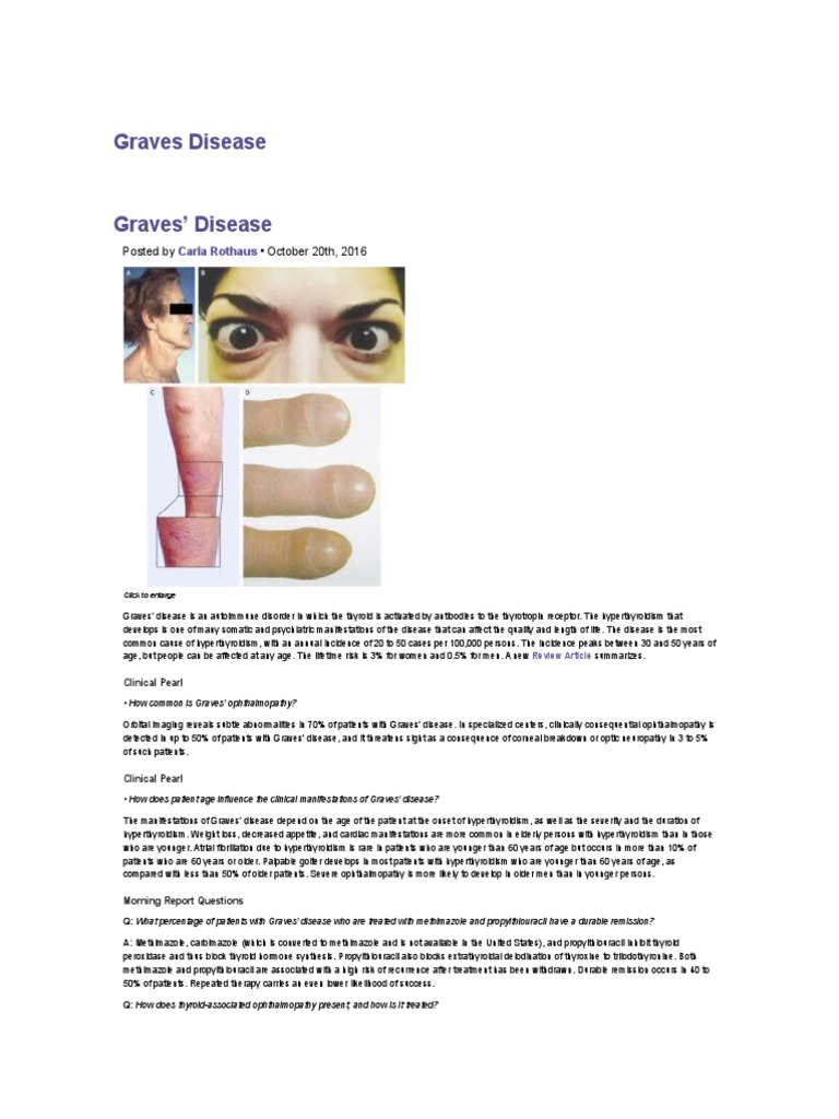 Graves Disease: Posted by | PDF | Hyperthyroidism | Human Anatomy