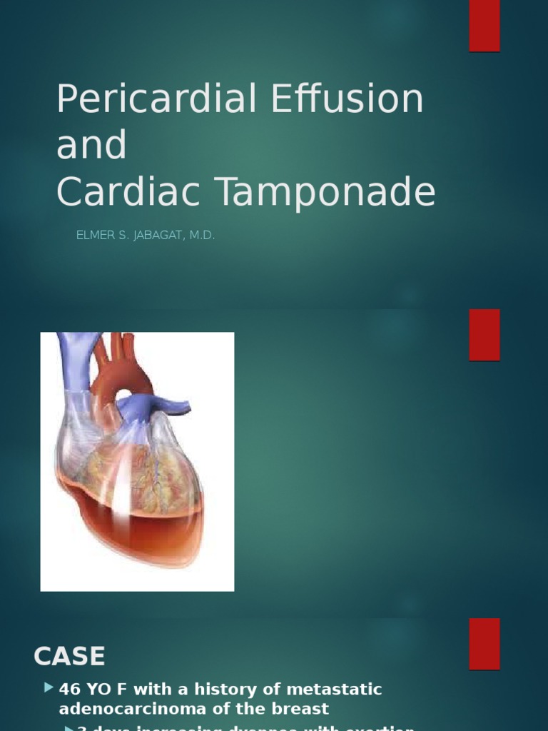 Pericardial Effusion | PDF | Heart | Electrocardiography
