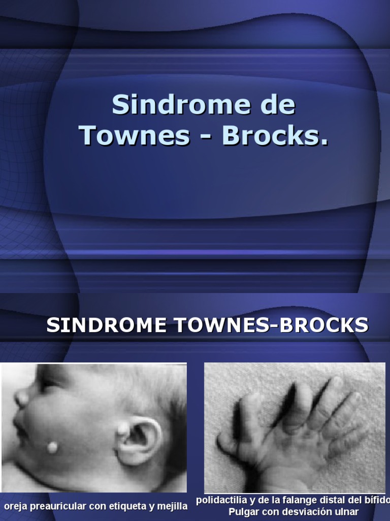 Síndrome Townes Brocks 2 | PDF | Hipotiroidismo | Infantes