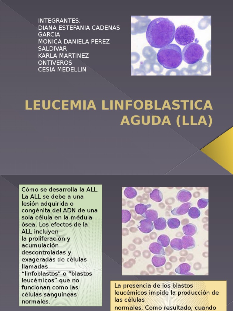 Leucemia LinfoBLASTICA Aguda (LLA) | PDF | Leucemia | Linfocitos