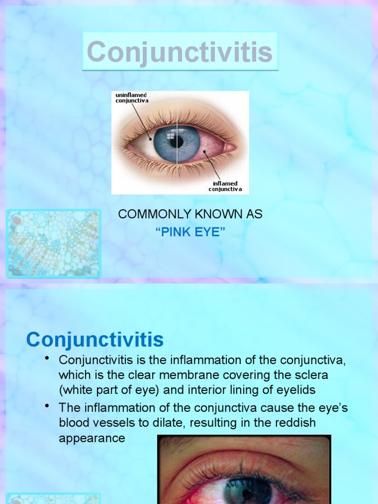 Understanding Conjunctivitis Symptoms & Treatment | PDF | Wellness