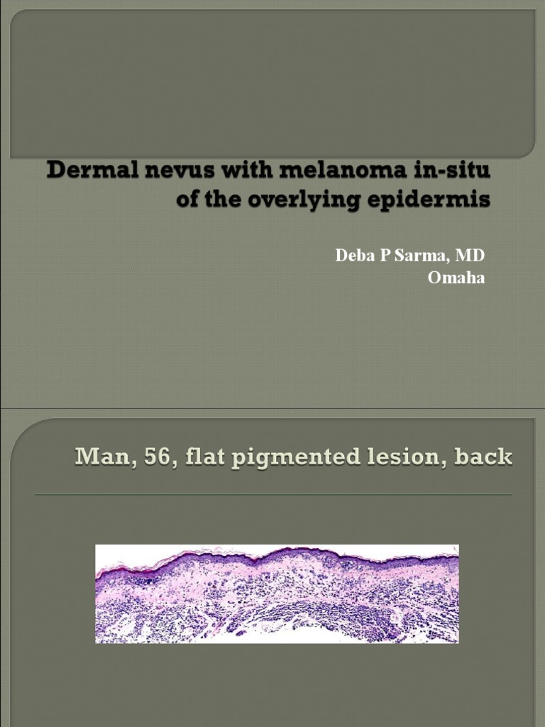 Dermal Nevus With Melanoma In-Situ of The Overlying Epidermis. M 56 ...